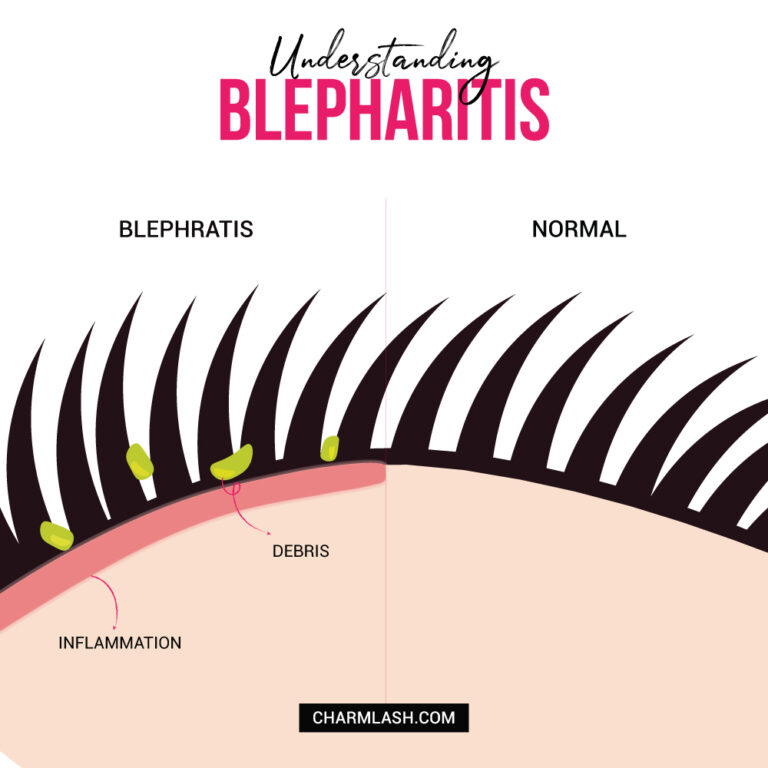 How To Prevent Blepharitis From Eyelash Extensions?