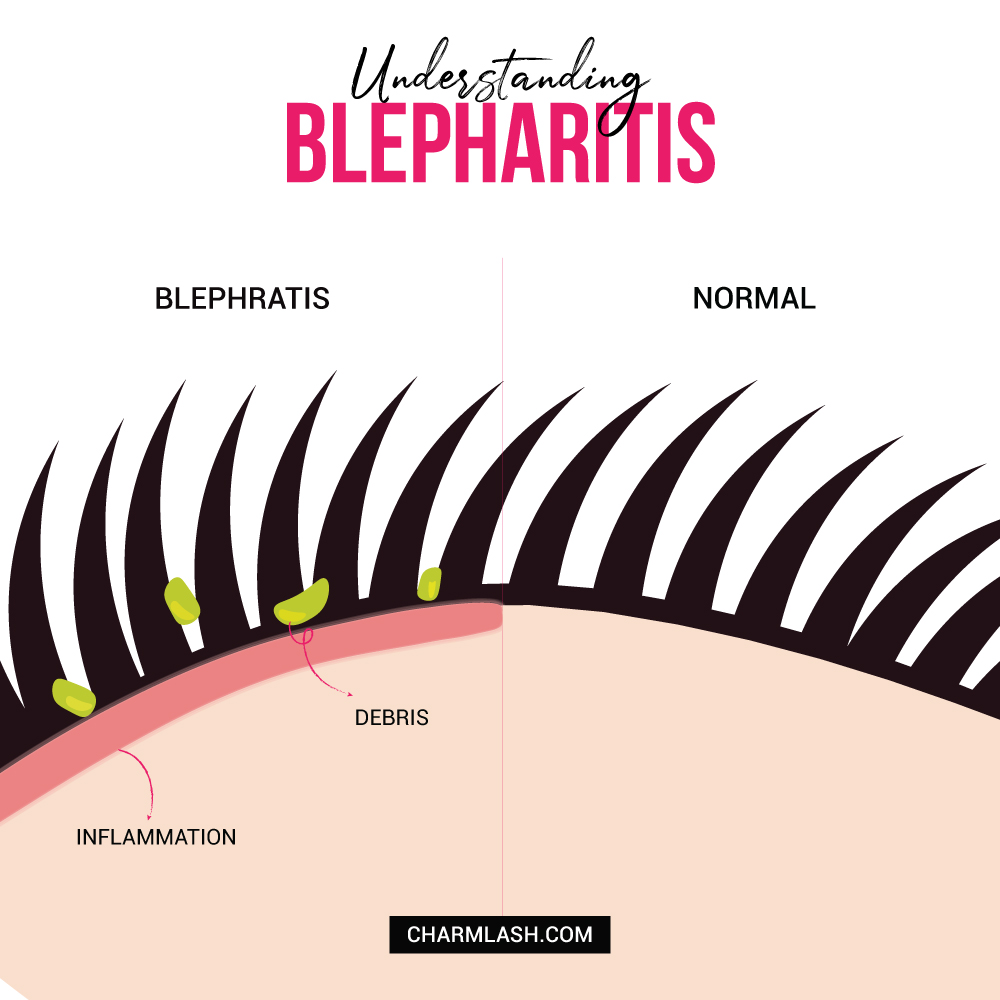 How To Prevent Blepharitis From Eyelash Extensions?