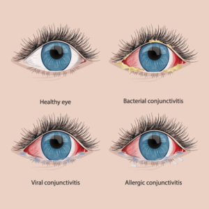 The Ultimate Guide On Lash Extension Infection
