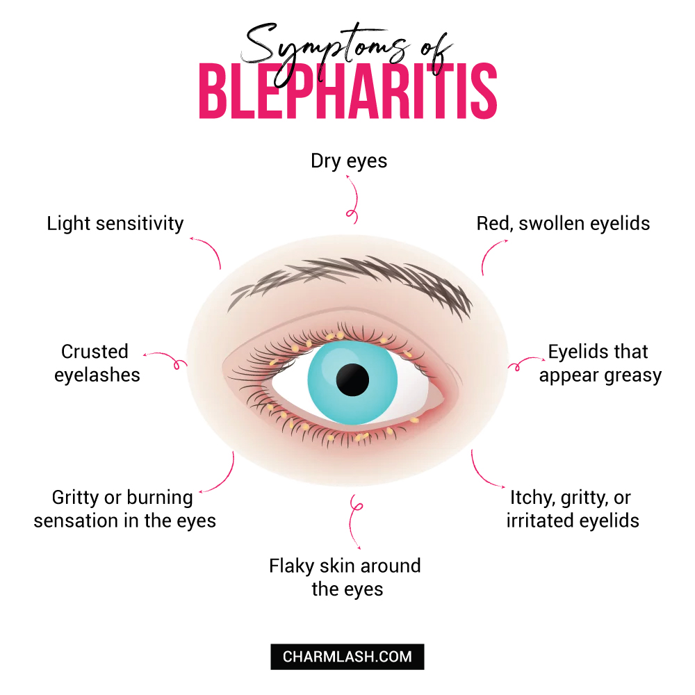 How To Prevent Blepharitis From Eyelash Extensions?